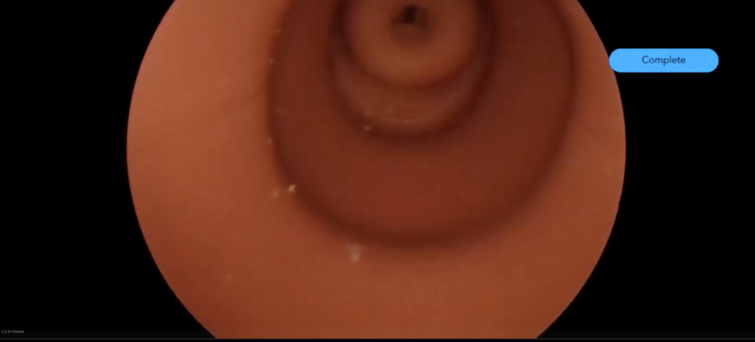 Inovus Medical | HystAR Pro